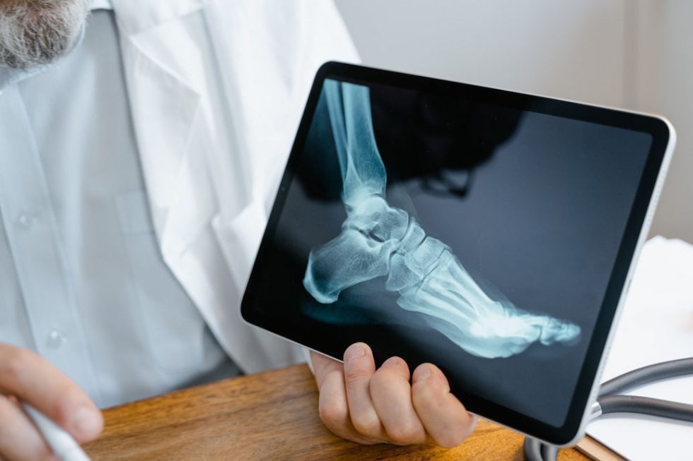Plantar Interdigital Neuroma - Eastbourne Podiatry